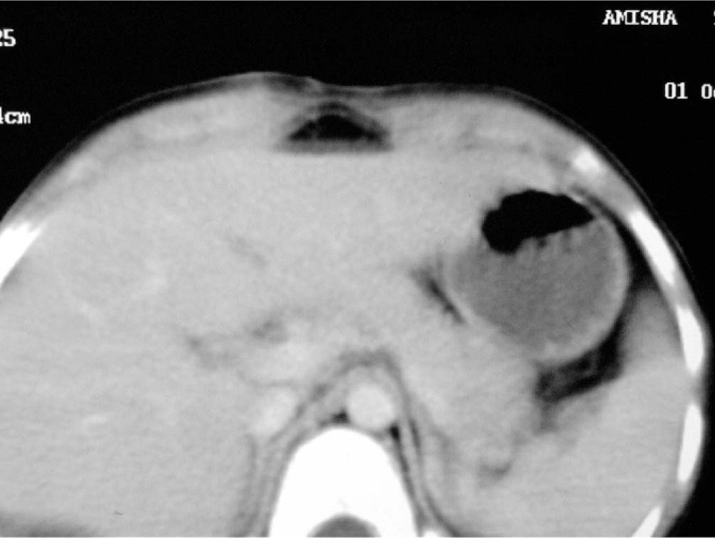 Dissemination of tubercular bacilli by shunt placement | Mohindra ...